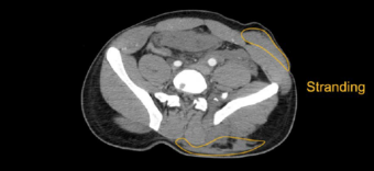 Abdominal CT: body wall injuries • LITFL • Radiology