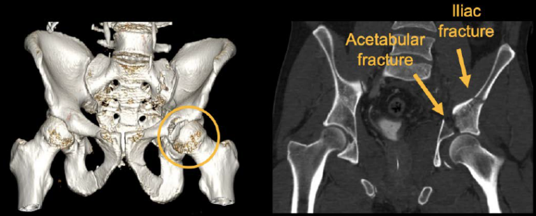 Abdominal CT: pelvic fractures • LITFL • Radiology