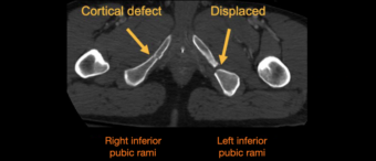 Abdominal CT: pelvic fractures • LITFL • Radiology