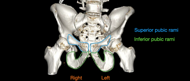 Abdominal CT: pelvic fractures • LITFL • Radiology