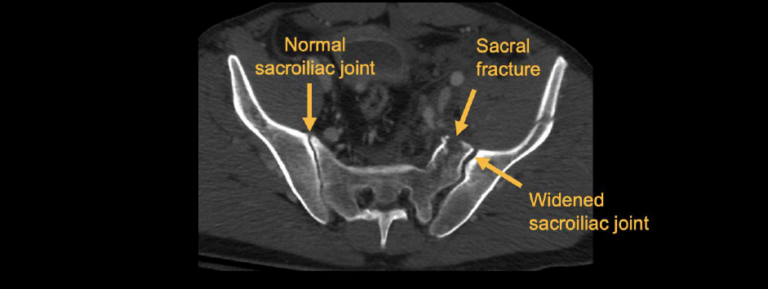 Abdominal CT: pelvic fractures • LITFL • Radiology