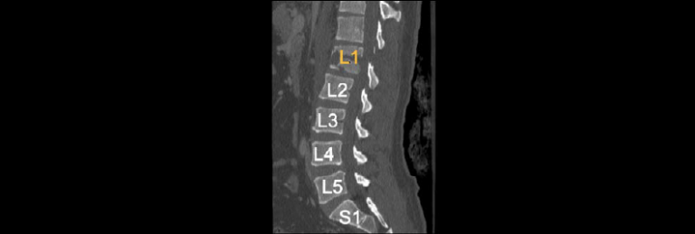 Abdominal CT: spinal fractures • LITFL • Radiology