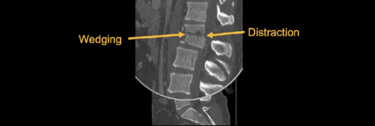 Abdominal CT: spinal fractures • LITFL • Radiology