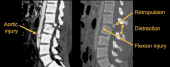 Abdominal CT: spinal fractures • LITFL • Radiology
