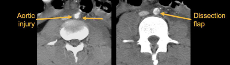 Abdominal CT: spinal fractures • LITFL • Radiology