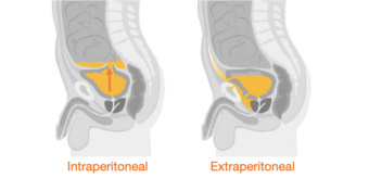 Abdominal CT: bladder injuries • LITFL • Radiology