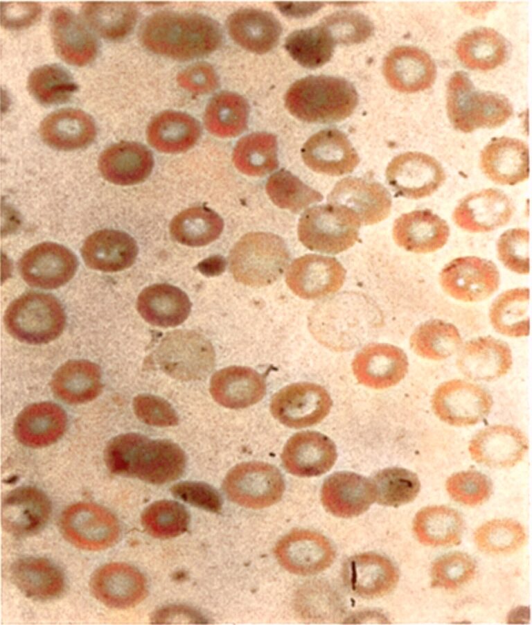 Kleihauer–Betke Test • LITFL • Medical Eponym Library