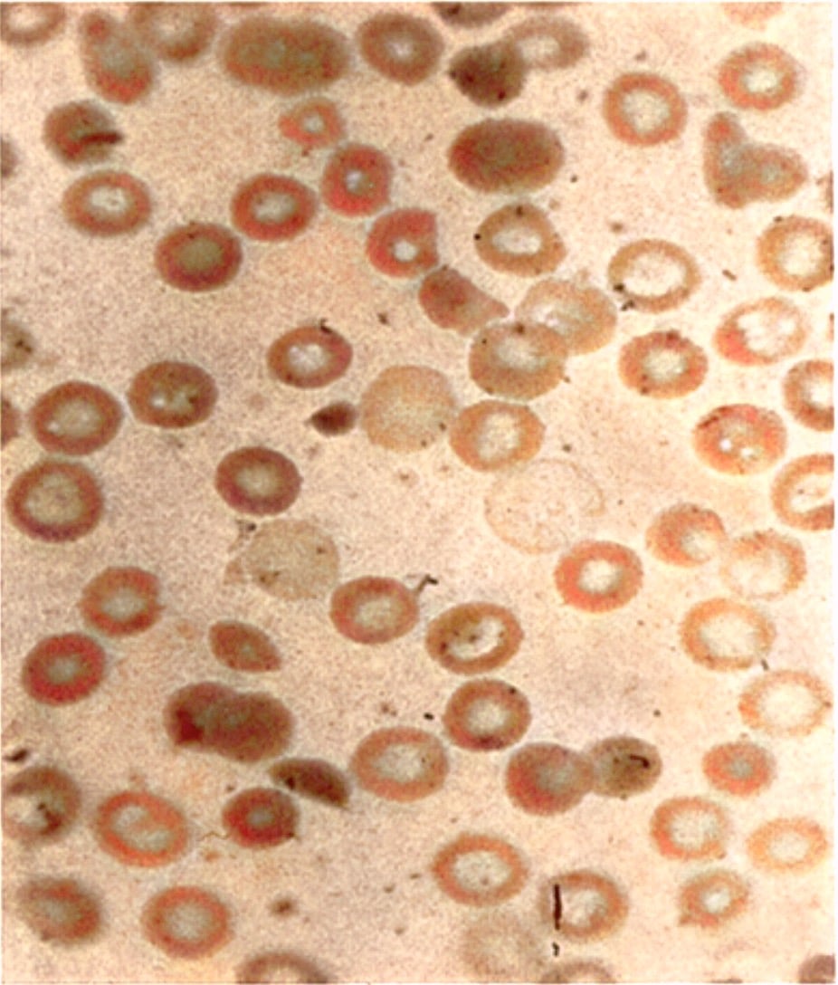 Kleihauer–Betke Test • LITFL • Medical Eponym Library