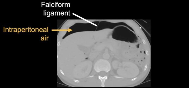 Bowel trauma (case studies) • LITFL • Radiology Library