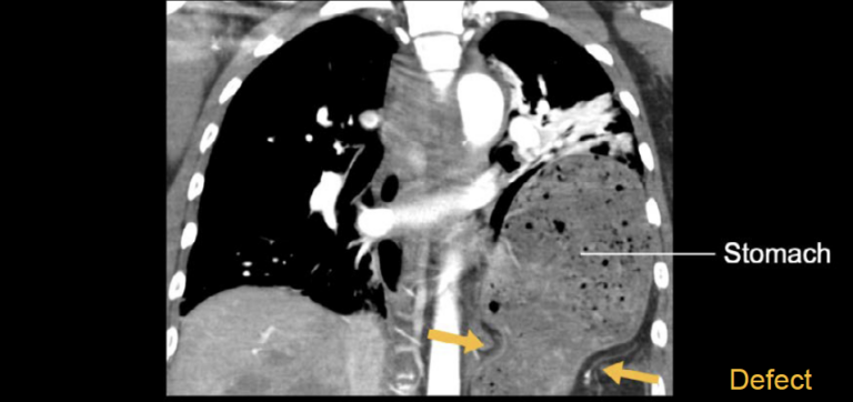 Abdominal CT: diaphragmatic injuries • LITFL • Radiology
