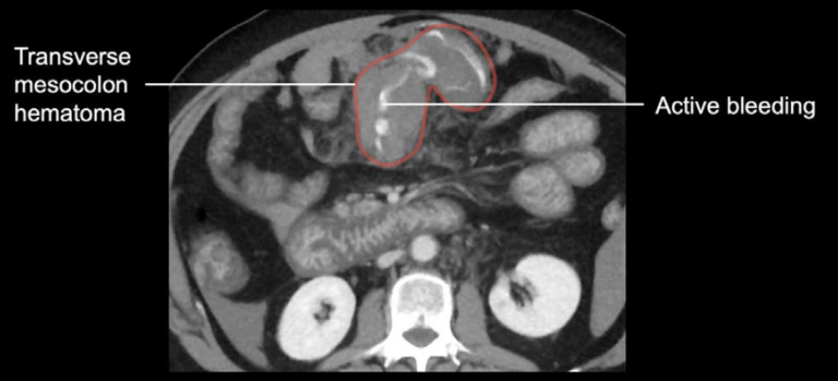 Mesenteric injury (case studies) • LITFL • Radiology Library