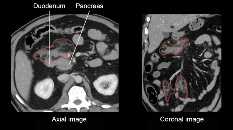 Mesenteric injury (case studies) • LITFL • Radiology Library