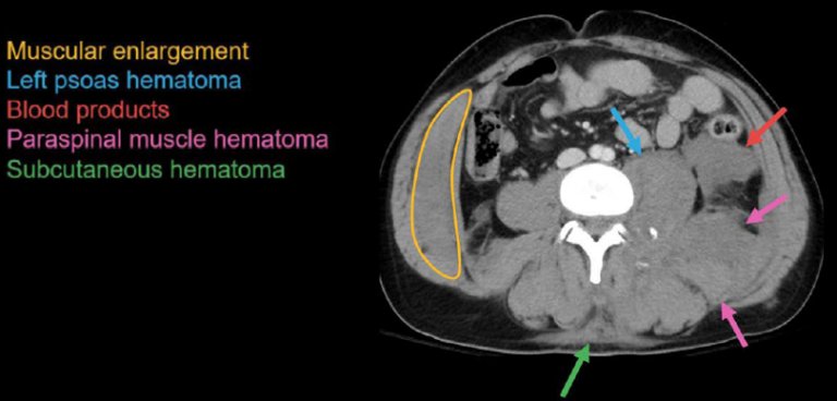Abdominal CT: body wall injuries • LITFL • Radiology