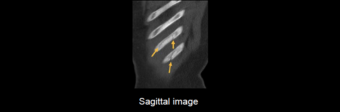 Abdominal CT: rib fractures • LITFL • Radiology