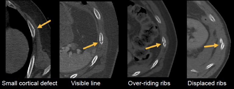 Abdominal Ct Rib Fractures • Litfl • Radiology