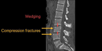 Abdominal CT: spinal fractures • LITFL • Radiology