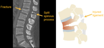 Abdominal CT: spinal fractures • LITFL • Radiology
