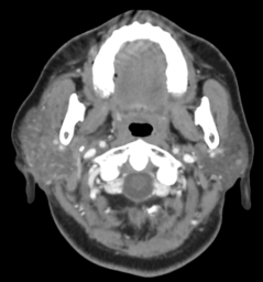 CT Case 073 • LITFL • CT scan interpretation
