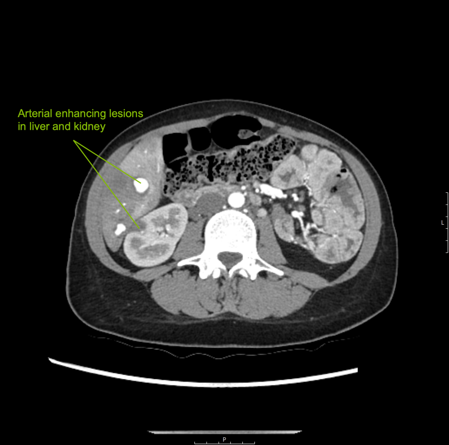 CT Case 075 • LITFL • CT scan interpretation