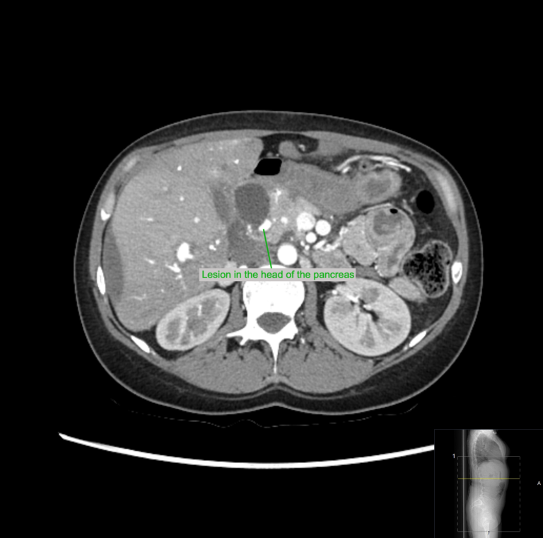 CT Case 075 • LITFL • CT scan interpretation