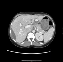 CT Case 075 • LITFL • CT scan interpretation