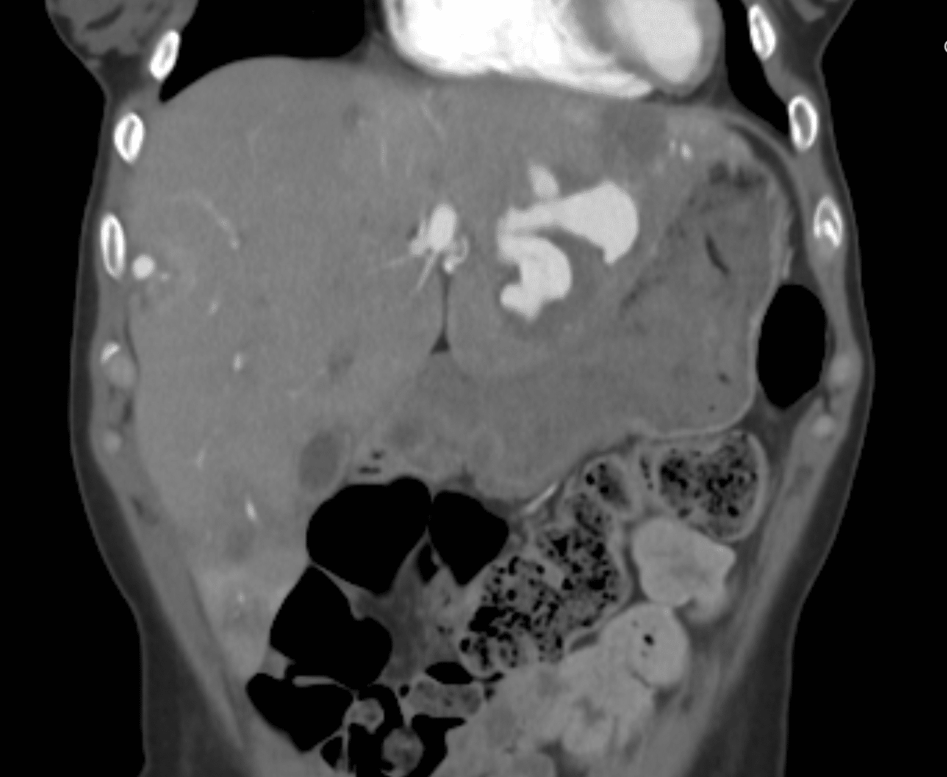 CT Case 075 • LITFL • CT scan interpretation