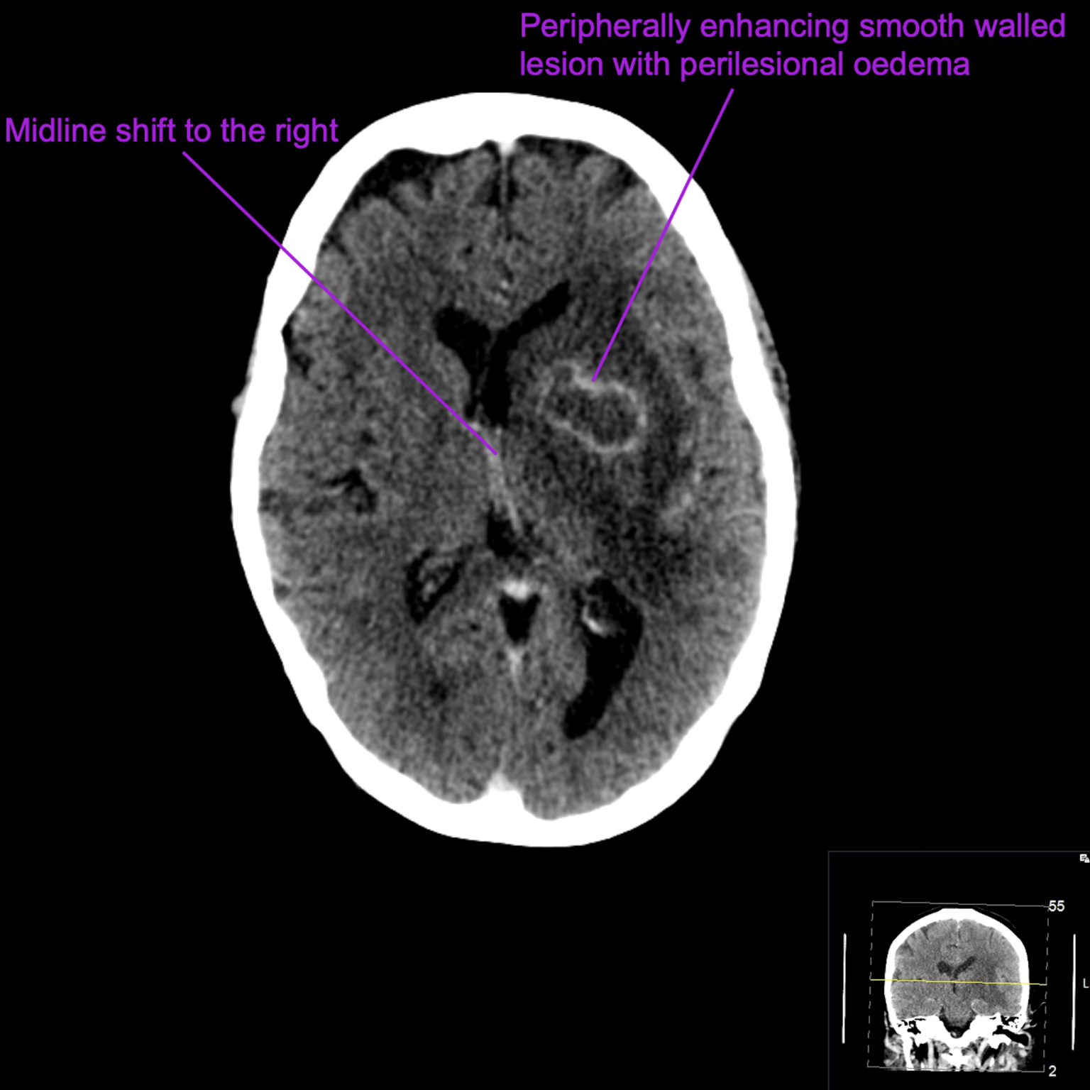CT Case 079 • LITFL • CT scan interpretation