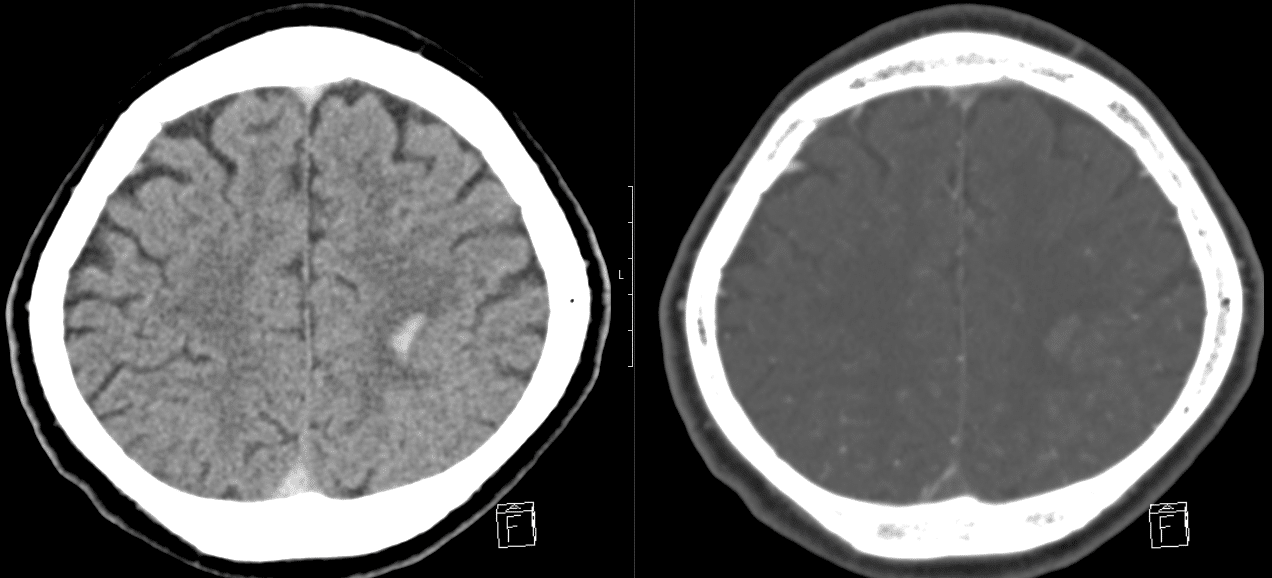 CT Case 082 • LITFL • CT scan interpretation