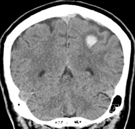 CT Case 082 • LITFL • CT scan interpretation