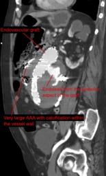 CT Case 084 • LITFL • CT scan interpretation