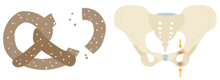Abdominal CT: pelvic fractures • LITFL • Radiology