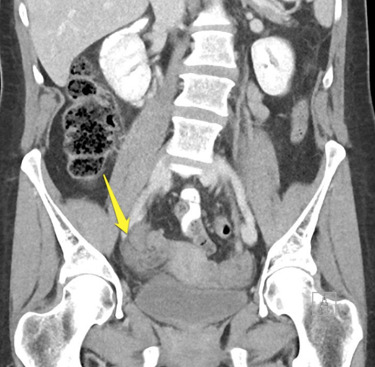 Ovarian torsion • LITFL • Fellowship Notes