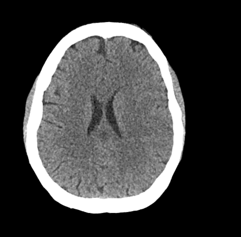 CT Case 061 • LITFL • CT scan interpretation