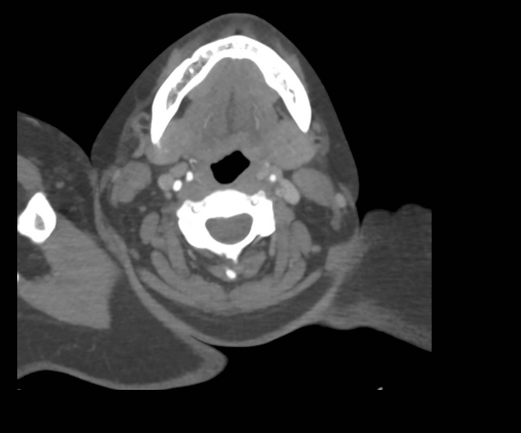 CT Case 061 • LITFL • CT scan interpretation
