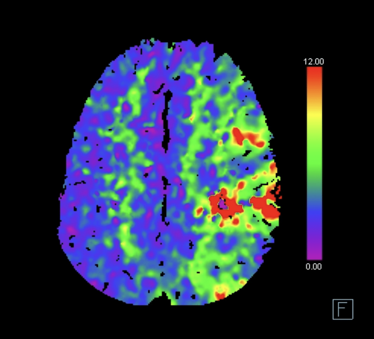CT Case 061 • LITFL • CT scan interpretation