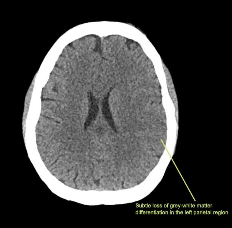 CT Case 061 • LITFL • CT scan interpretation