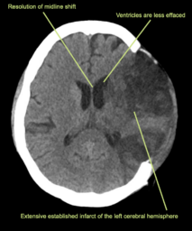 CT Case 061 • LITFL • CT scan interpretation