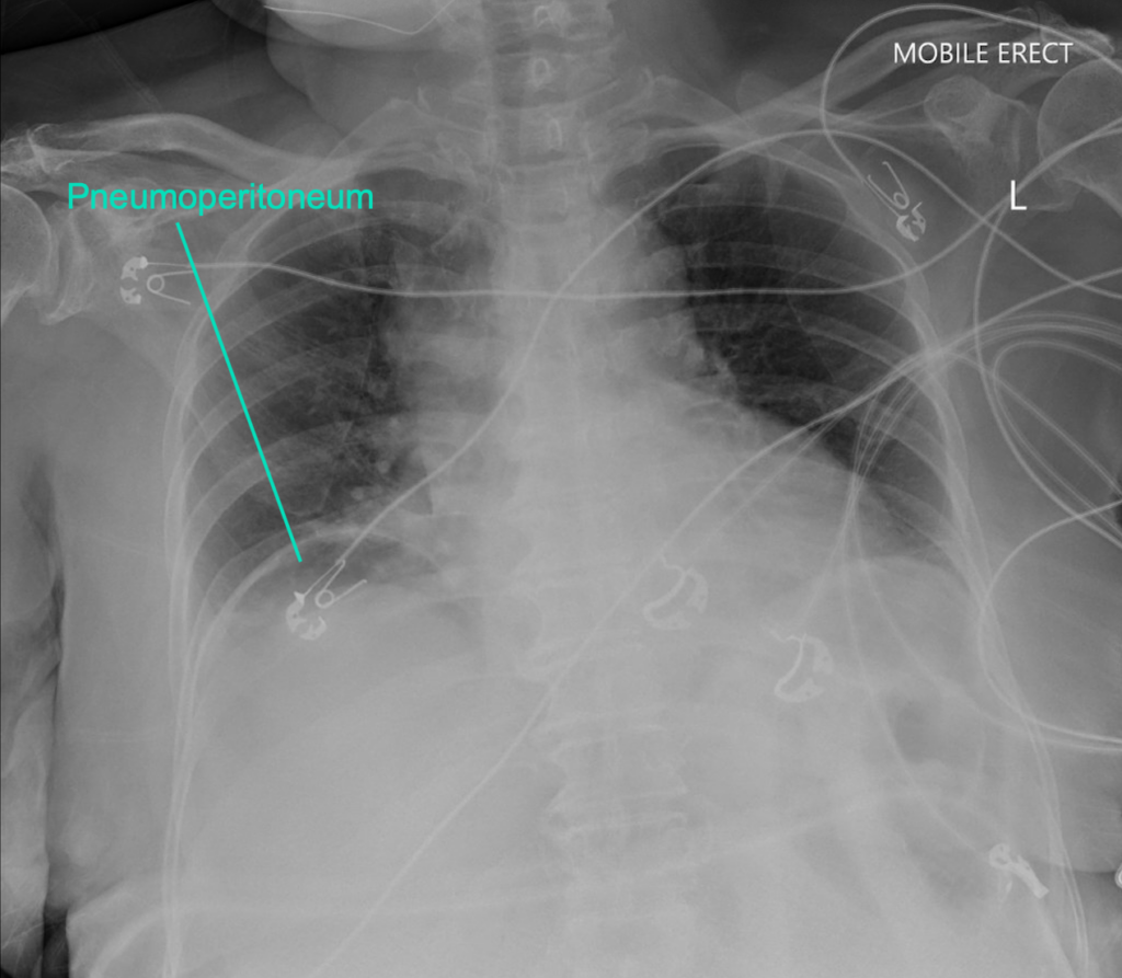 CT Case 062 • LITFL • CT scan interpretation
