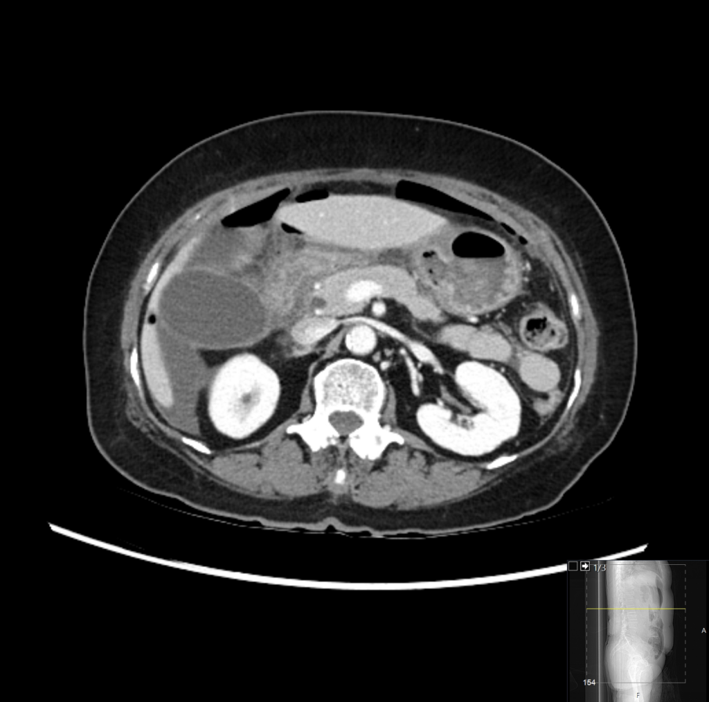 CT Case 062 • LITFL • CT scan interpretation