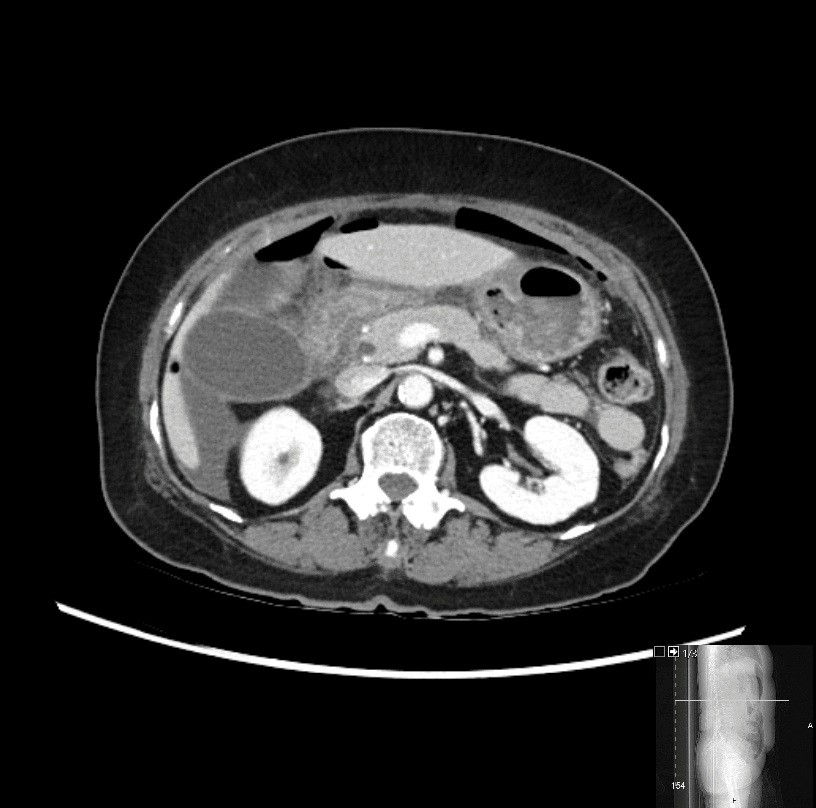 CT Case 062 • LITFL • CT scan interpretation