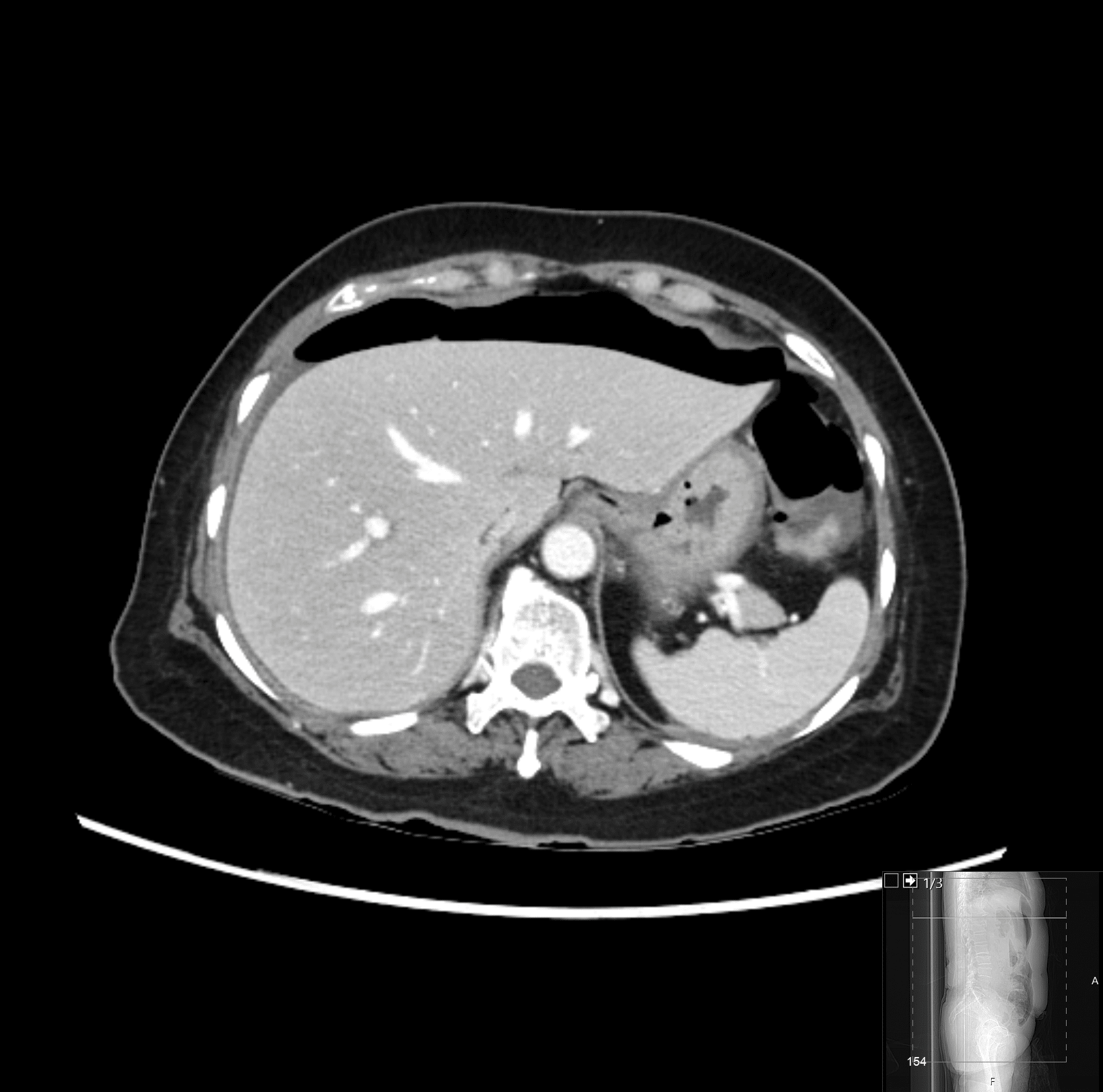 CT Case 062 • LITFL • CT scan interpretation