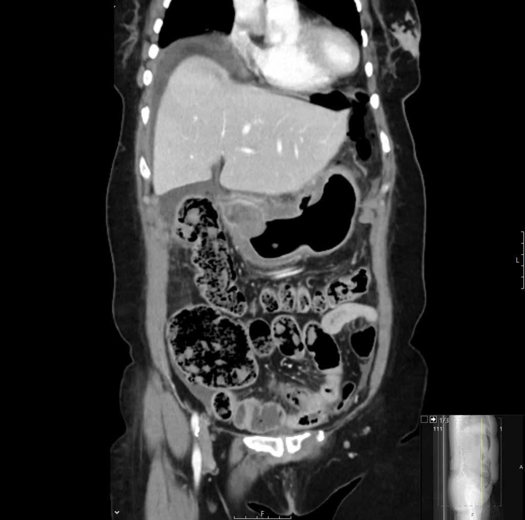 CT Case 062 • LITFL • CT scan interpretation
