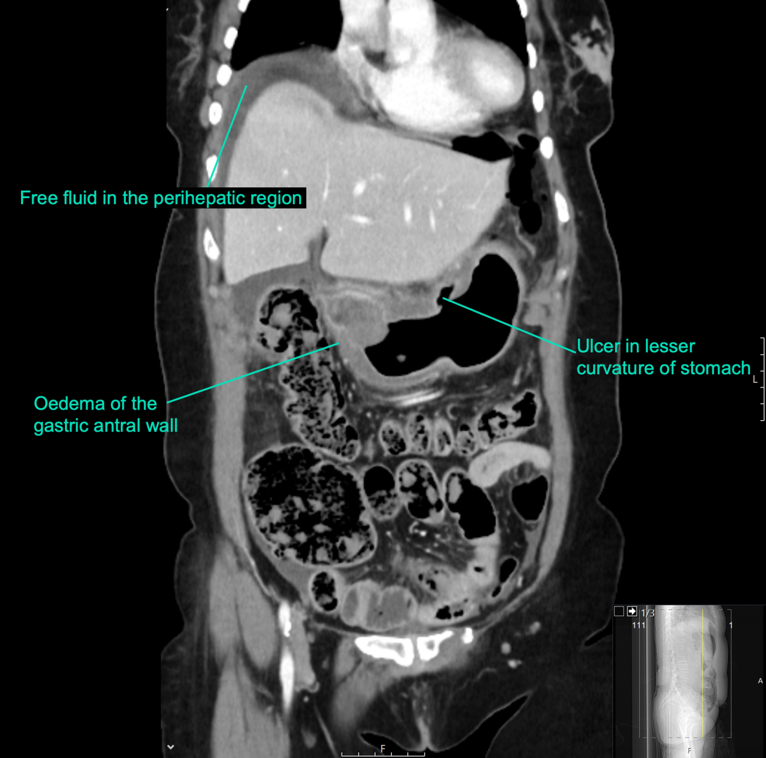 CT Case 062 • LITFL • CT scan interpretation