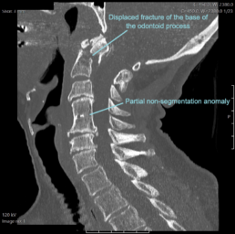 CT Case 063 • LITFL • CT scan interpretation