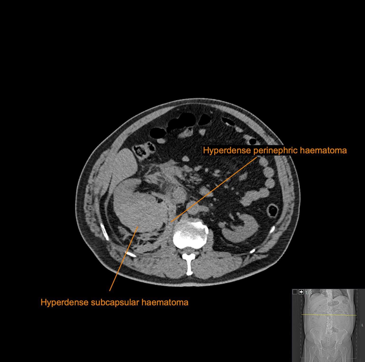 CT Case 064 • LITFL • CT scan interpretation