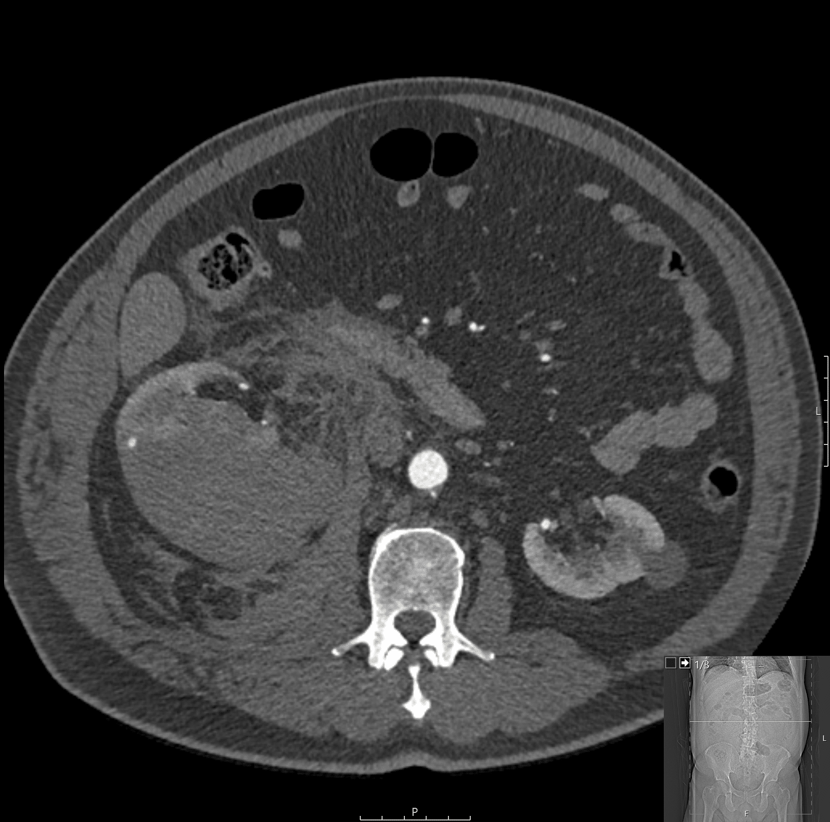 CT Case 064 • LITFL • CT scan interpretation