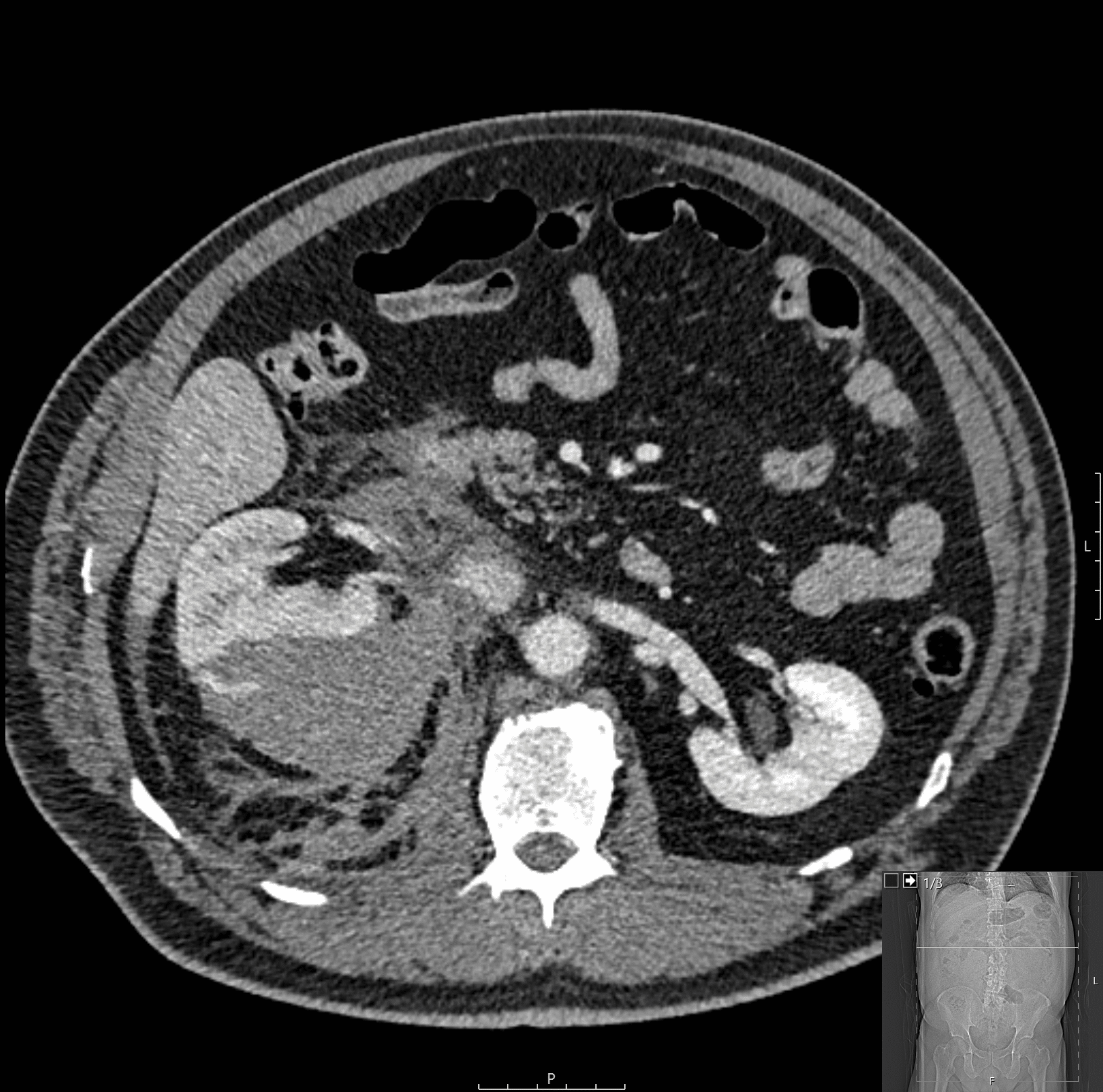 CT Case 064 • LITFL • CT scan interpretation