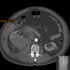 CT Case 064 • LITFL • CT scan interpretation