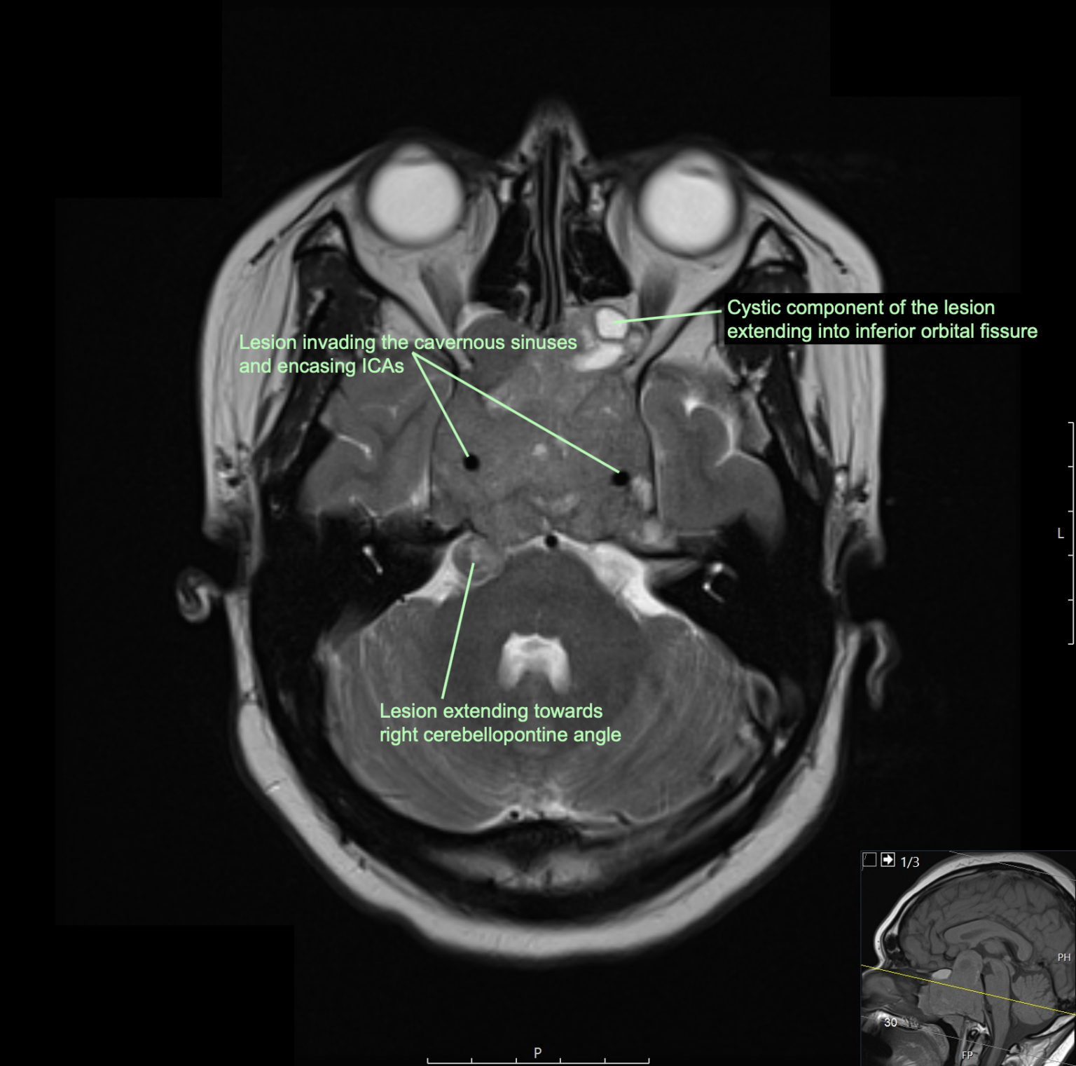 CT Case 065 • LITFL • CT scan interpretation
