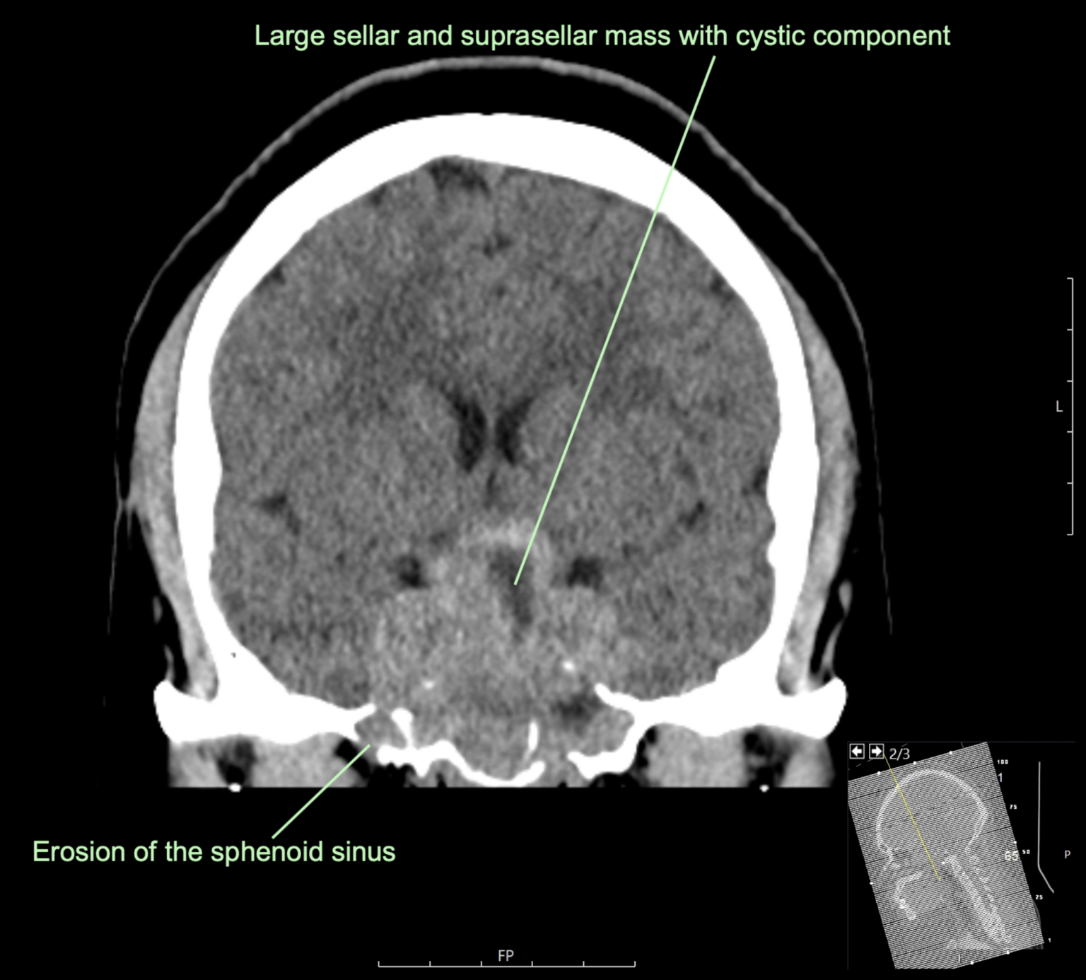 CT Case 065 • LITFL • CT scan interpretation